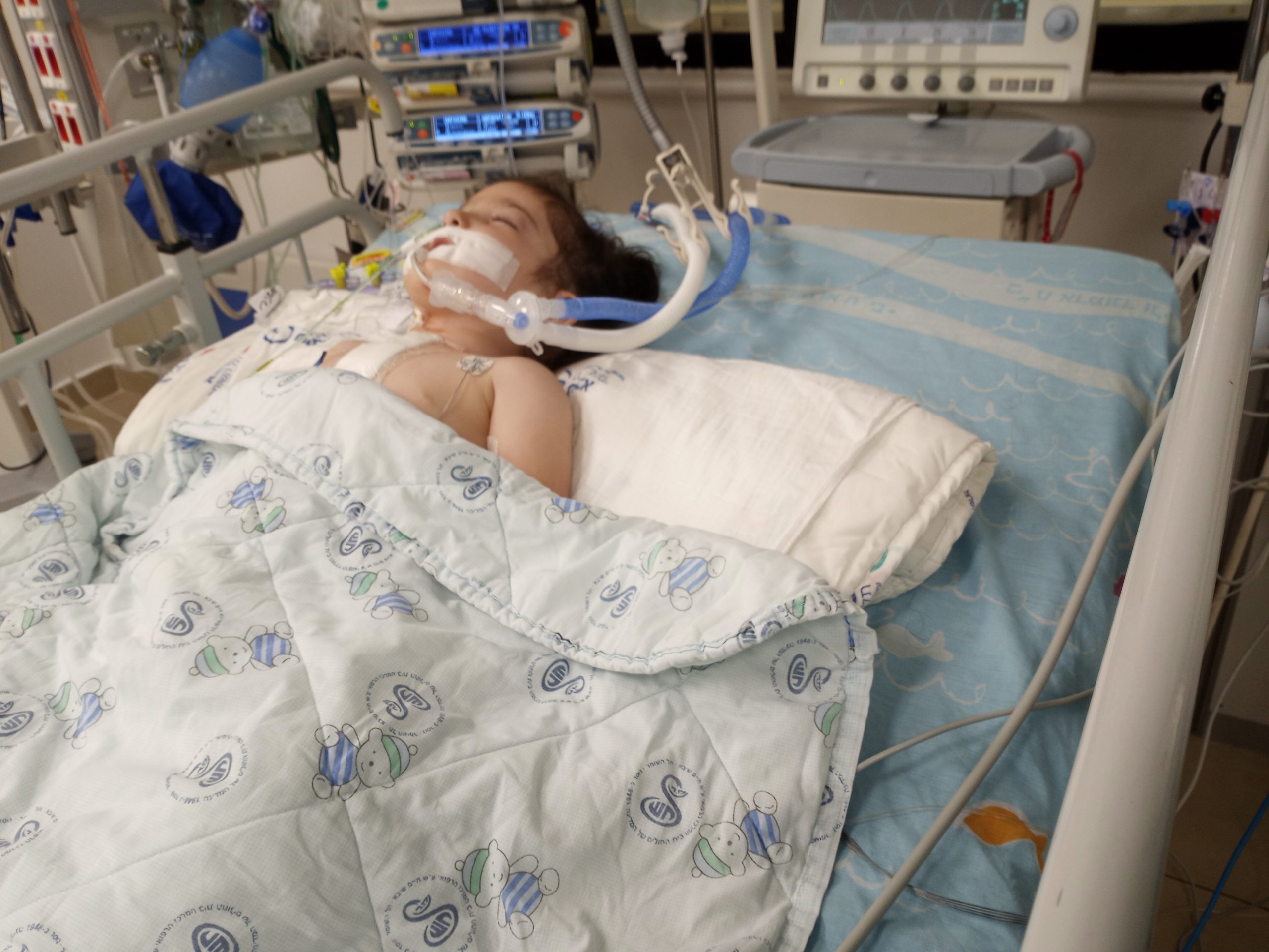 Extubated, but re-intubated due to throat swelling